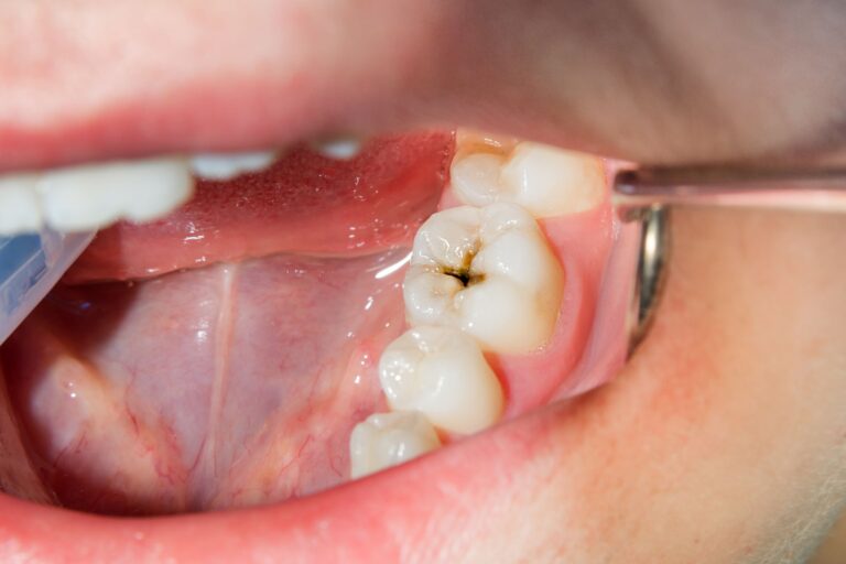 What to Expect When Getting Dental Fillings